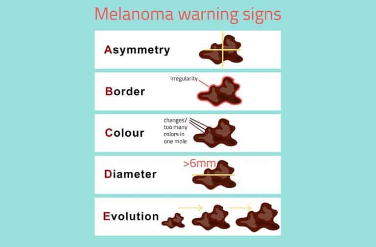 A Simple Guide to Identifying Early Signs of Skin Cancer: Checking Your ...