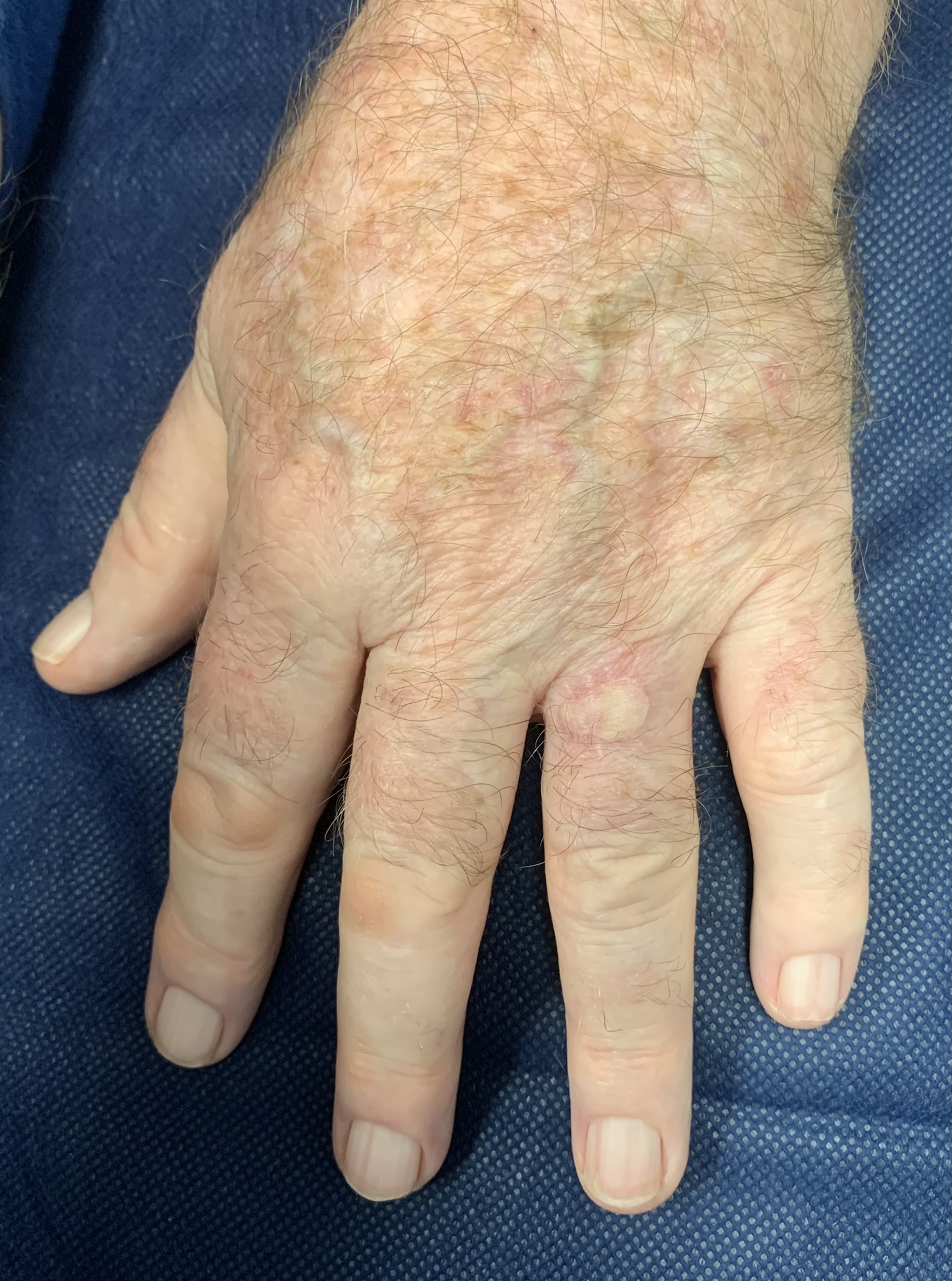 Advanced Skin Cancer Treatment: Effective Solutions for Optimal Recovery